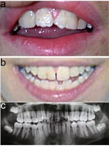 Macrodontia - Tysons Dental Spa